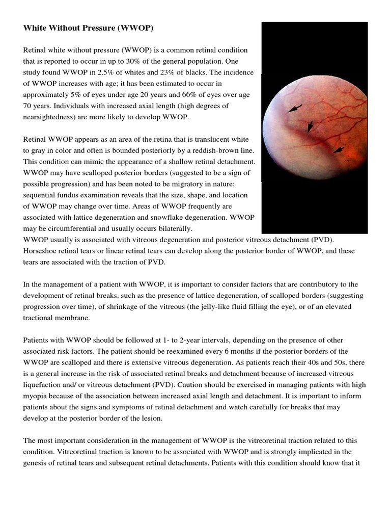 White Without Pressure | PDF | Vision | Ophthalmology