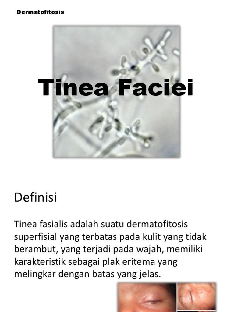 Tinea Faciei | PDF