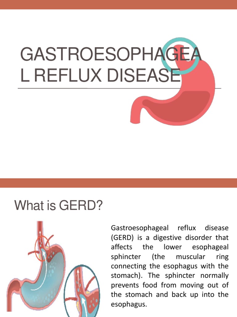 Understanding GERD: Symptoms & Treatments | PDF | Gastroesophageal ...