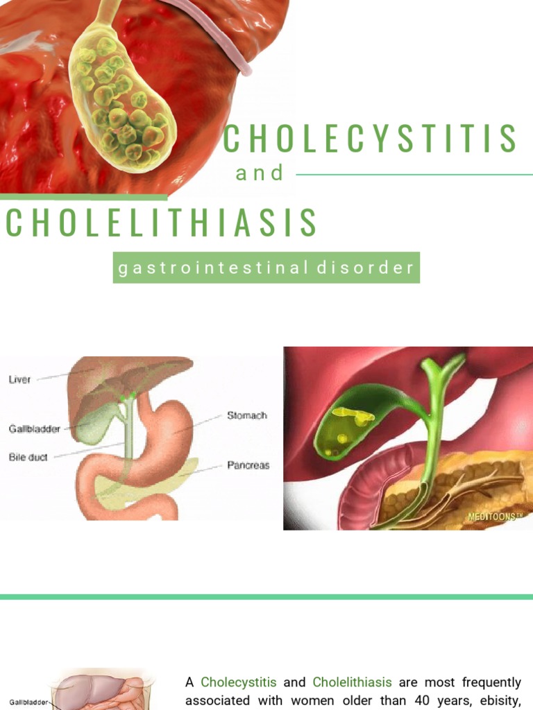 Cholecystitis and Cholelithiasis | PDF | Gallbladder | Digestive System
