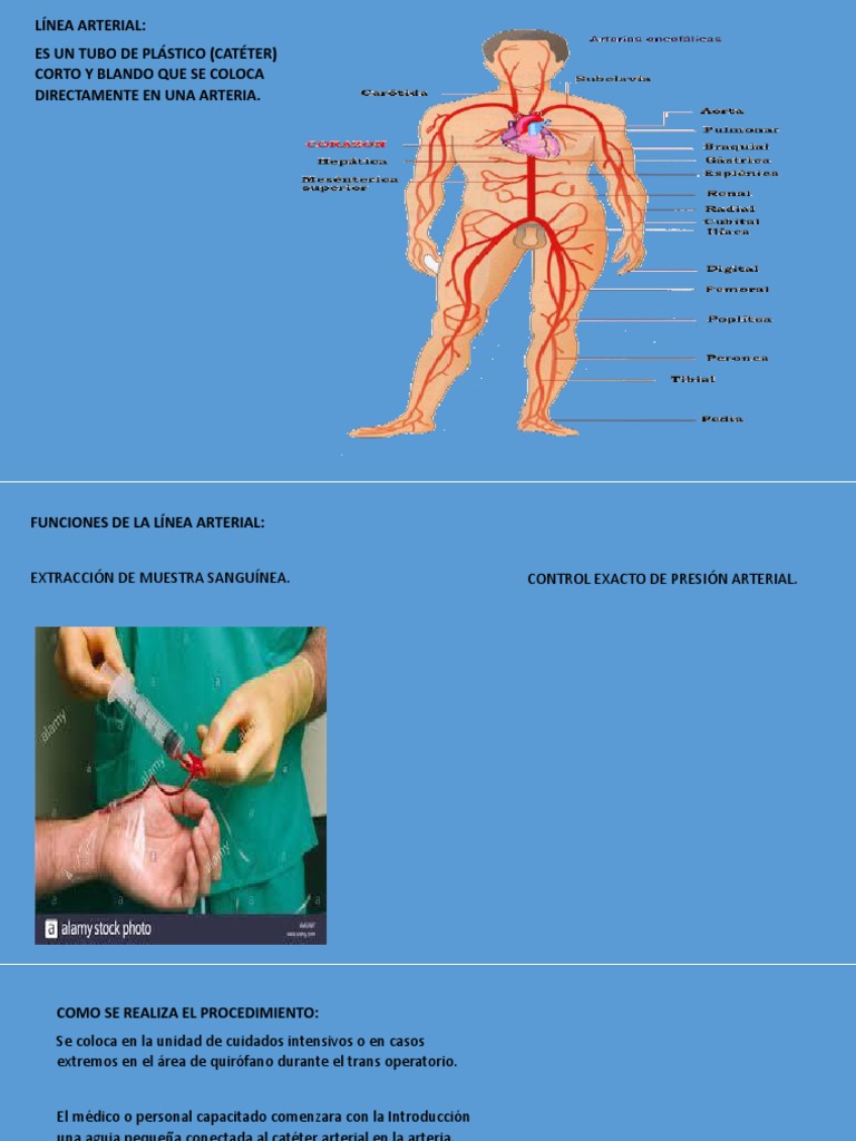 Linea Arterial .... | PDF