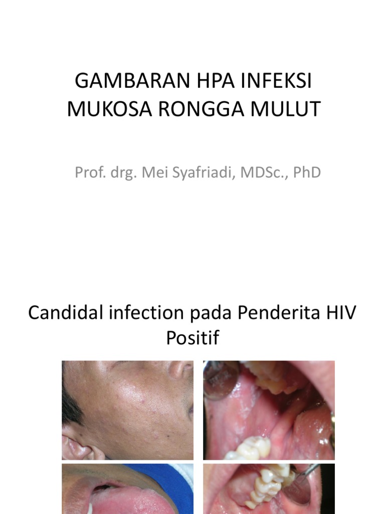 Gambaran Hpa Infeksi Mukosa Rongga Mulut | PDF
