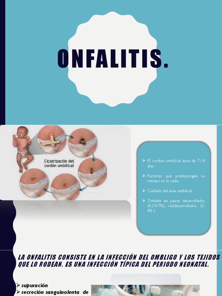 Onfalitis | PDF