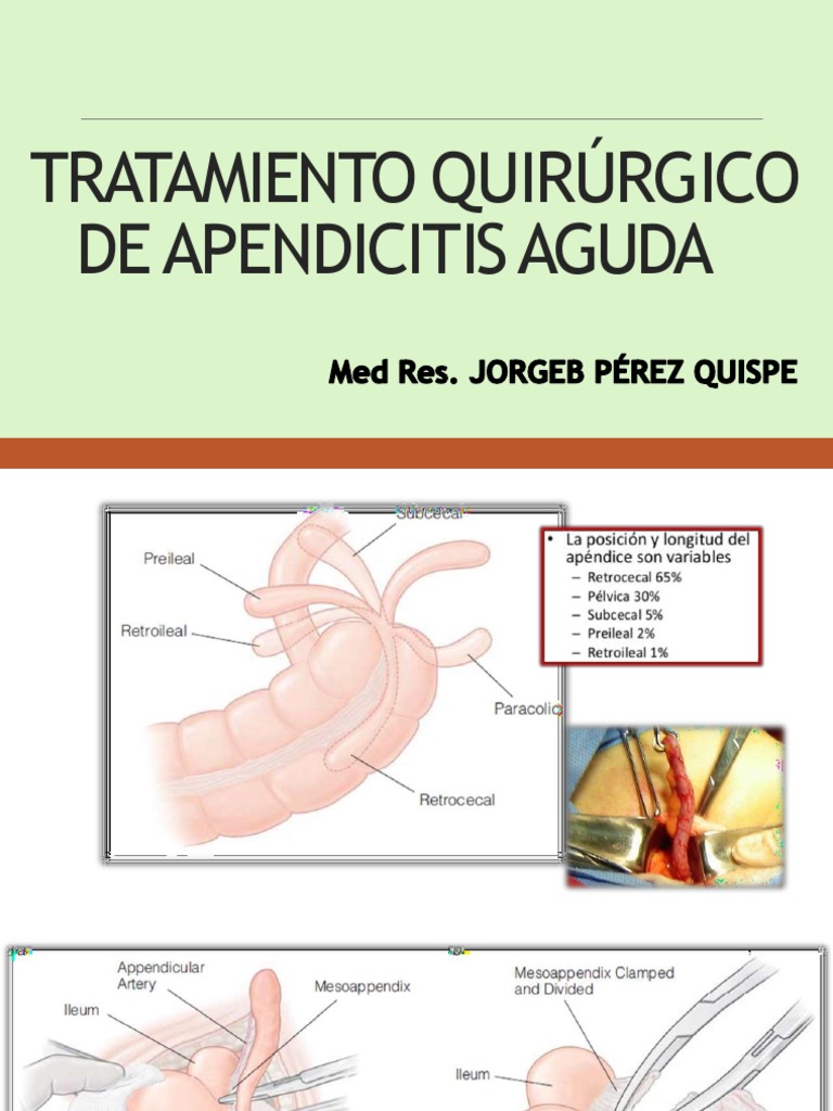 Tratamiento Quirurgico de La Apendicitis Aguda | PDF