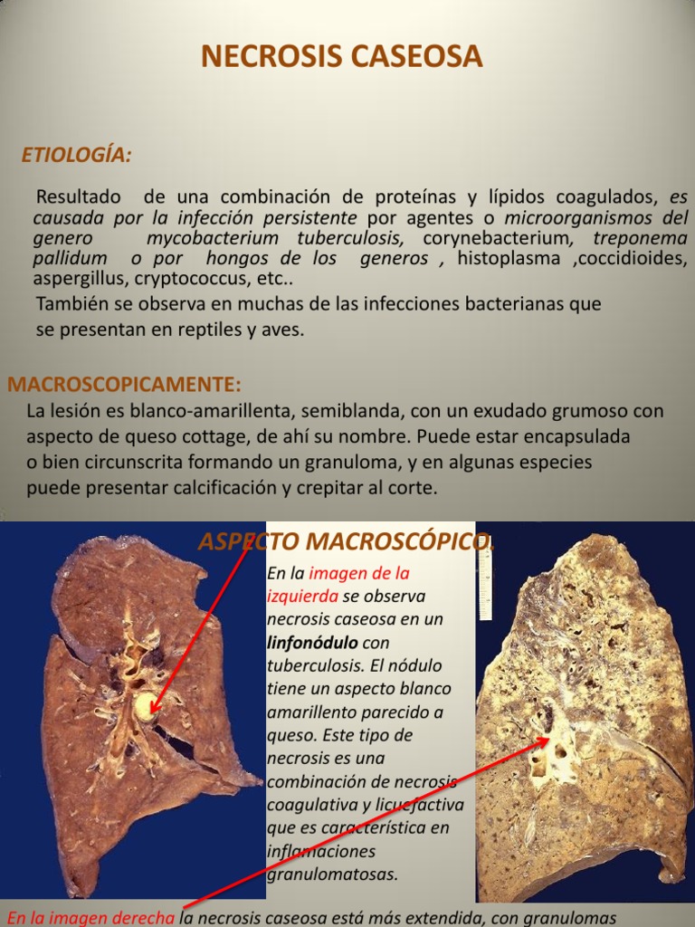 Necrosis Caseosa PDF | PDF | Inflamación | Epidemiología