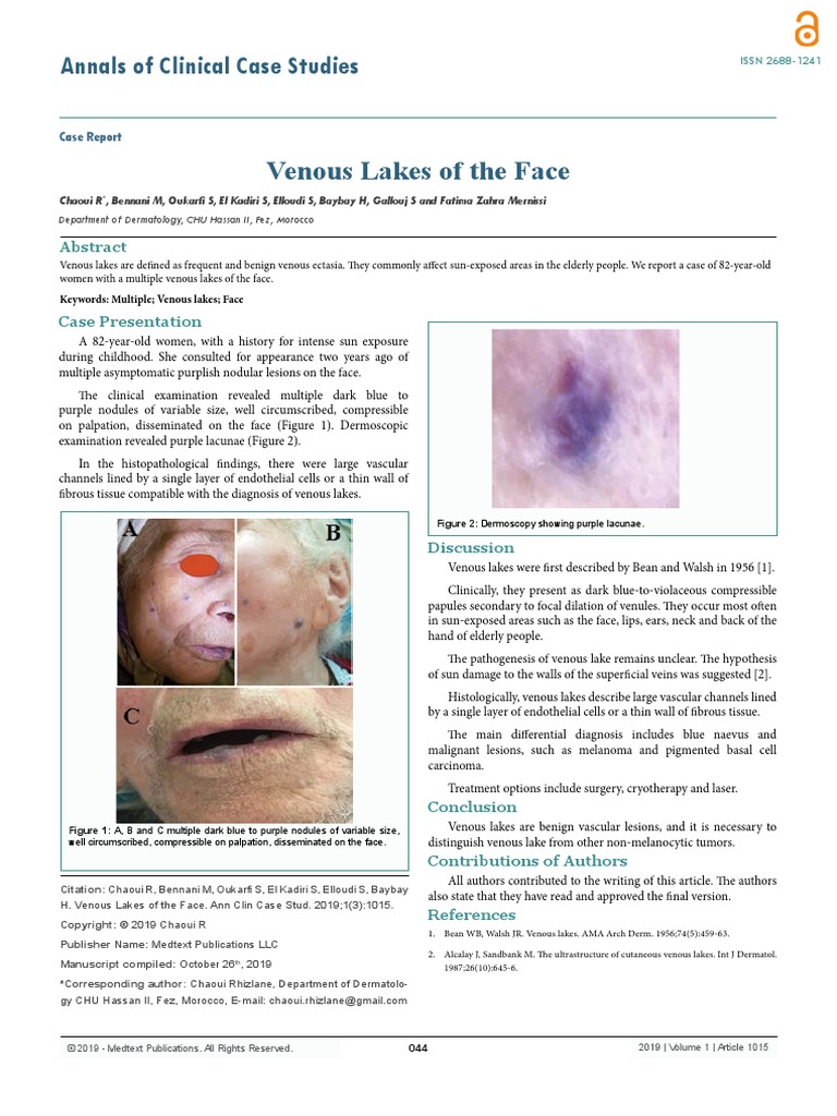 Venous Lakes of The Face 253 | PDF | Benign Tumor | Vein