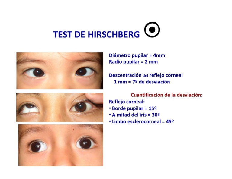 Test de Hirschberg en Estrabismo | PDF