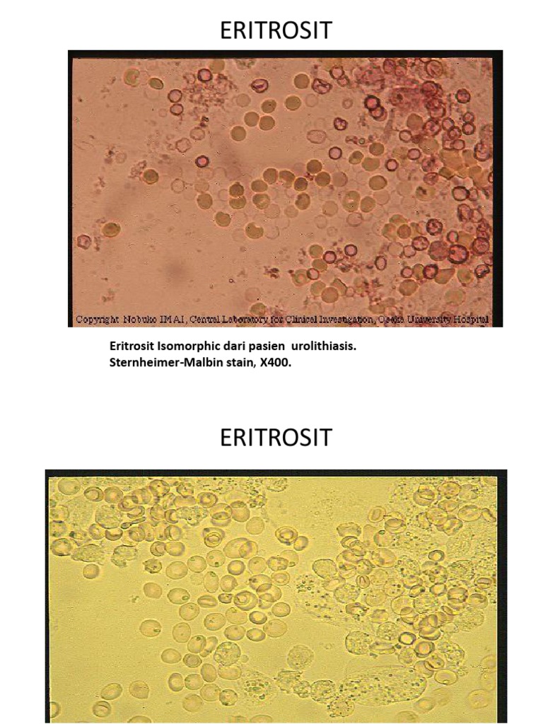 Gambar Sedimen Urin | PDF