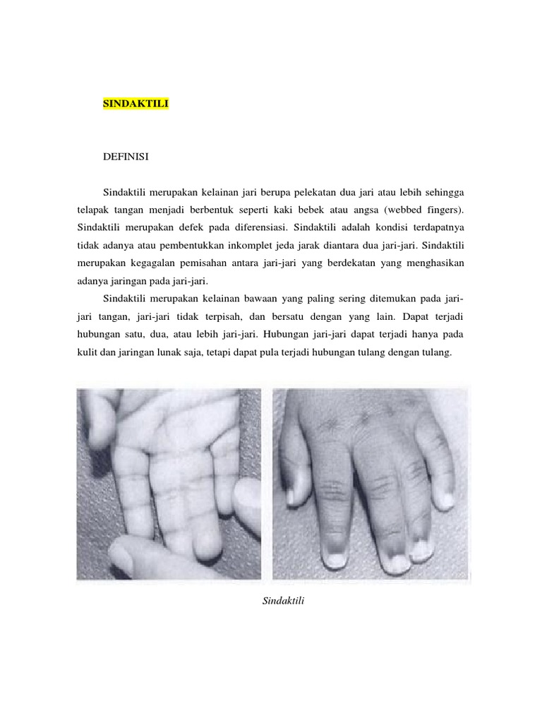Sindaktili: Penyebab dan Gejala | PDF