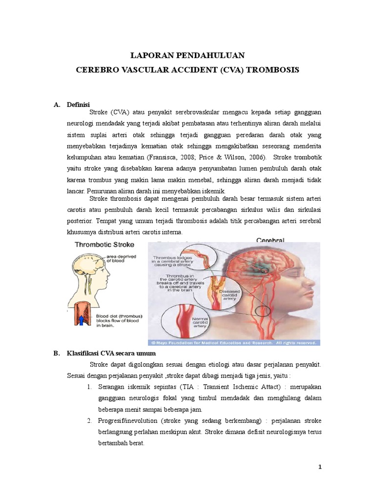 LP CVA Trombolisis | PDF