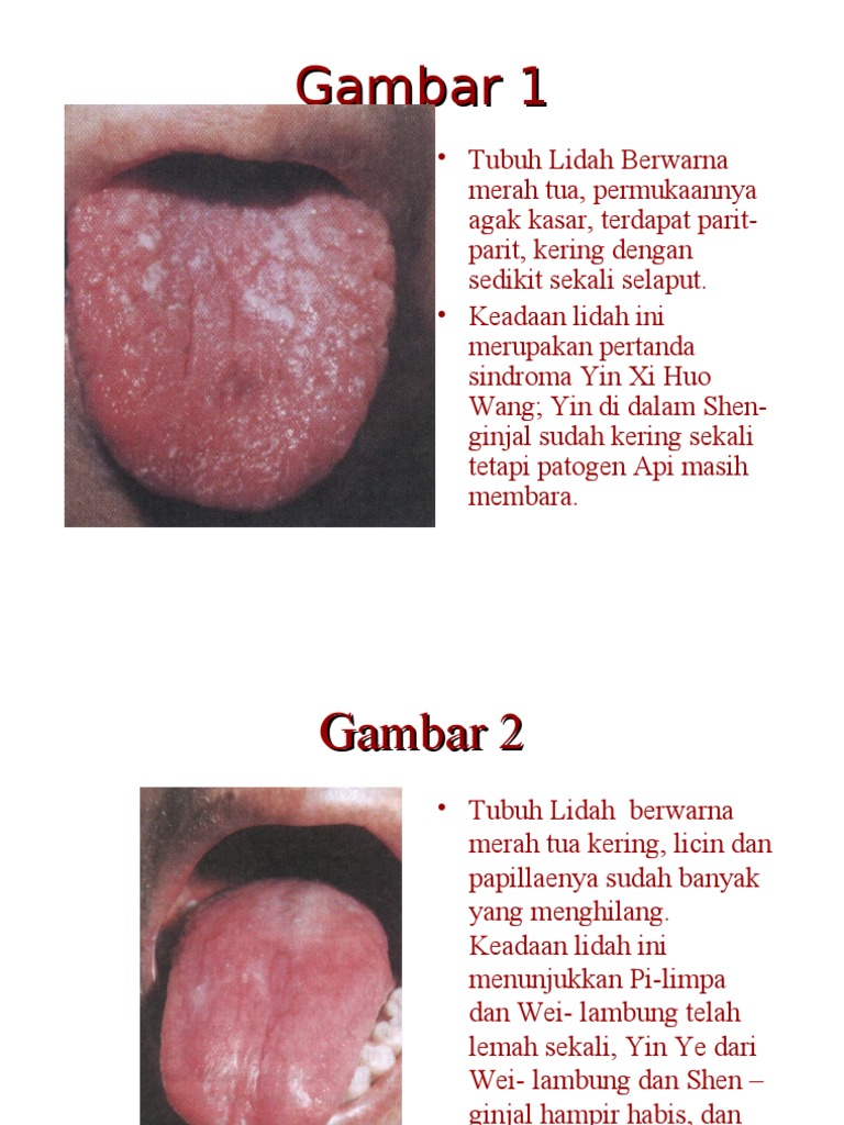 Acupuncture Diagnosis Lidah | PDF