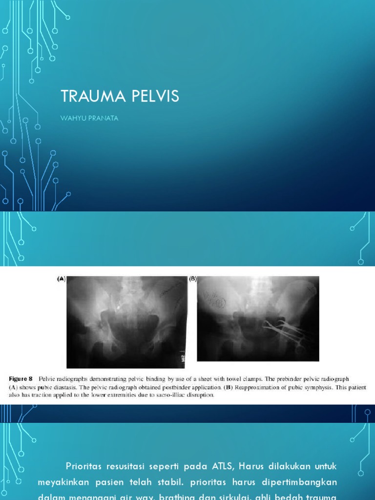 Trauma Pelvis-1 | PDF