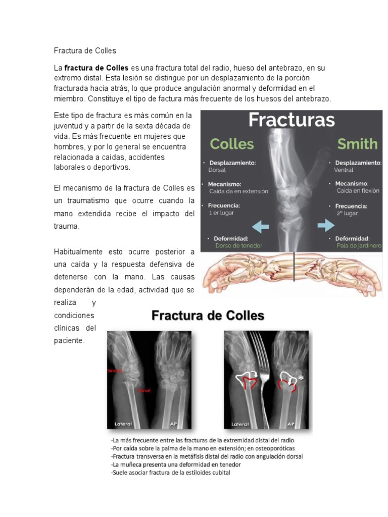 Fractura de Colles | PDF | Mano | Lesión