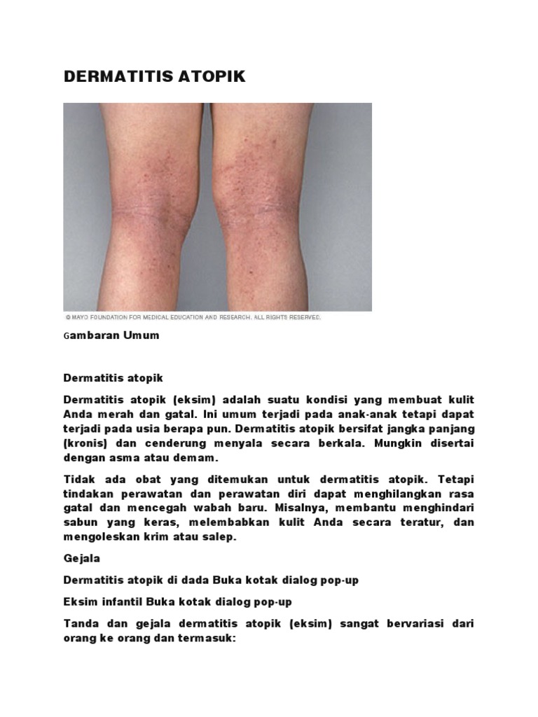 Dermatitis Atopik | PDF