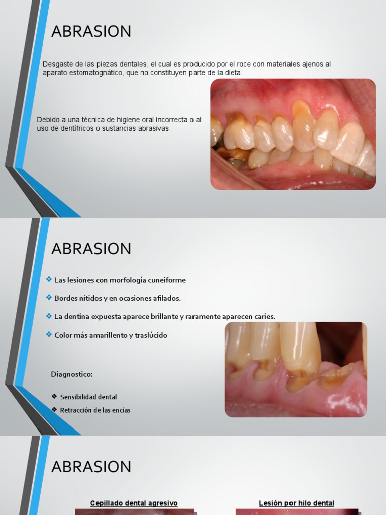 Abrasion, Atrición, Erosion | PDF | Diente | Ramas de Odontología