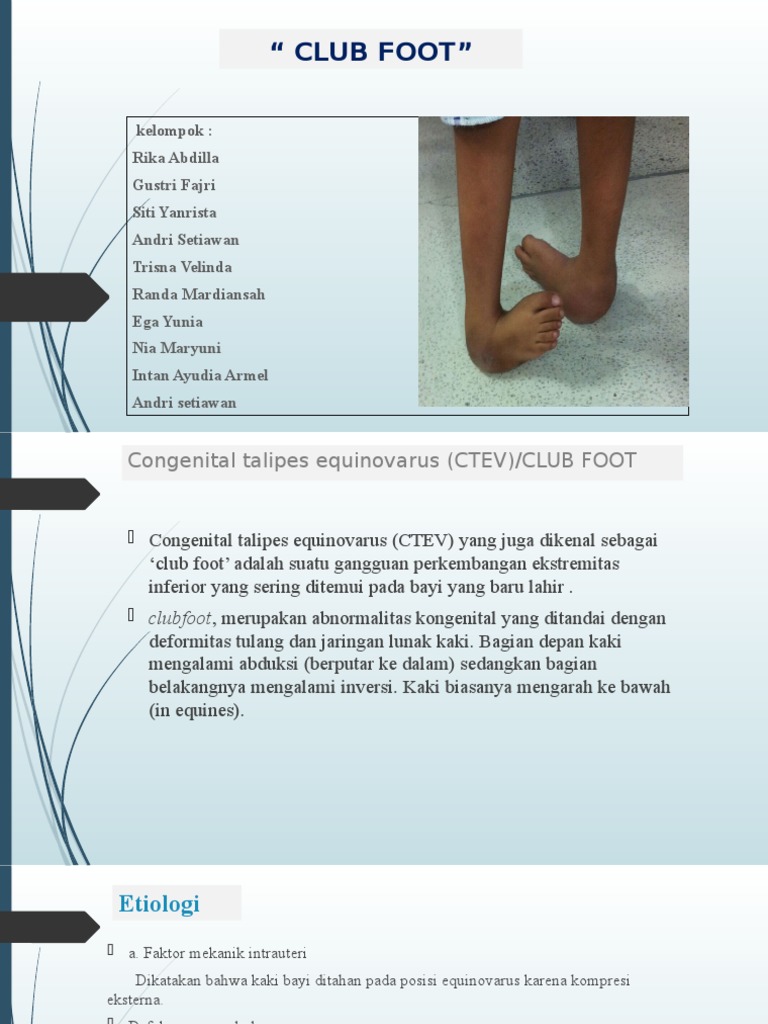 Club Foot | PDF