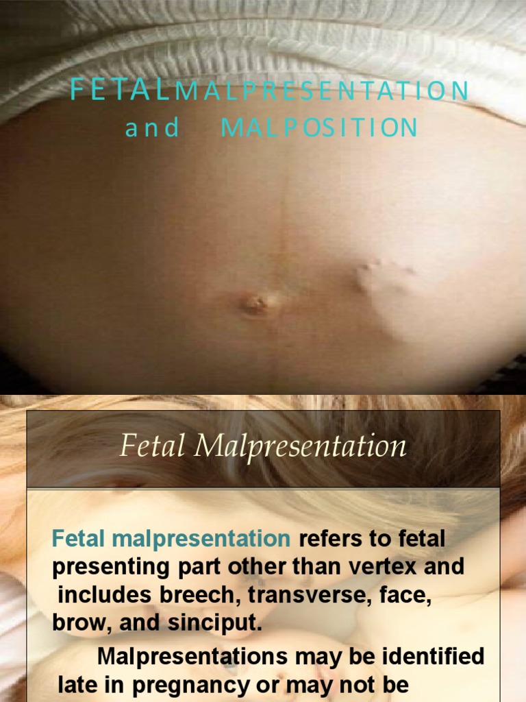 Malpresentation | PDF | Childbirth | Caesarean Section