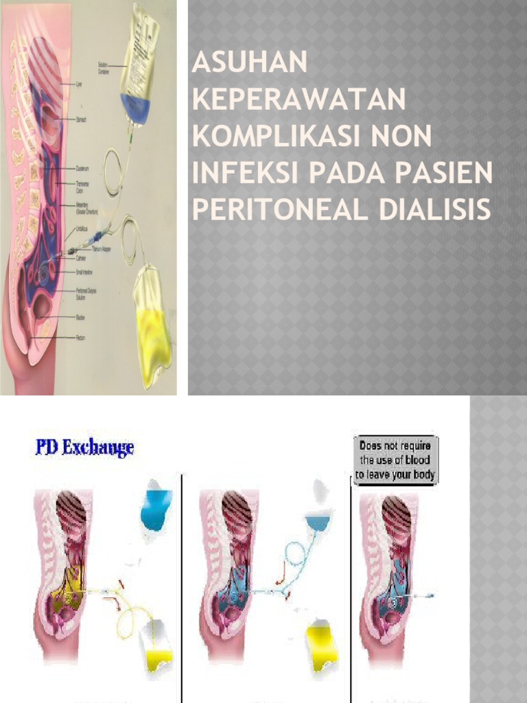 Askep Komplikasi Non Infeksi Capd | PDF