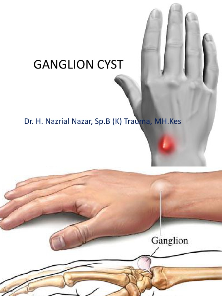 (Bedah Minor) Prinsip & Teknik Ekstraksi Ganglion Sederhana, Minggu, 13 ...