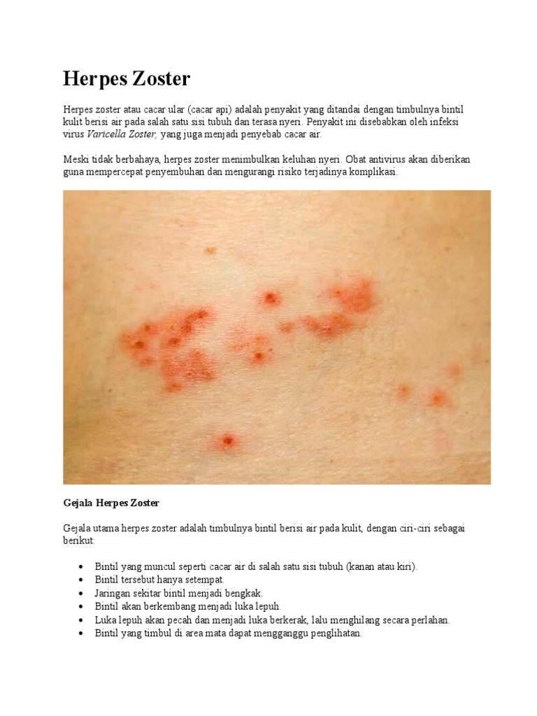 A Comprehensive Overview of Herpes Zoster: Symptoms, Causes, Diagnosis ...