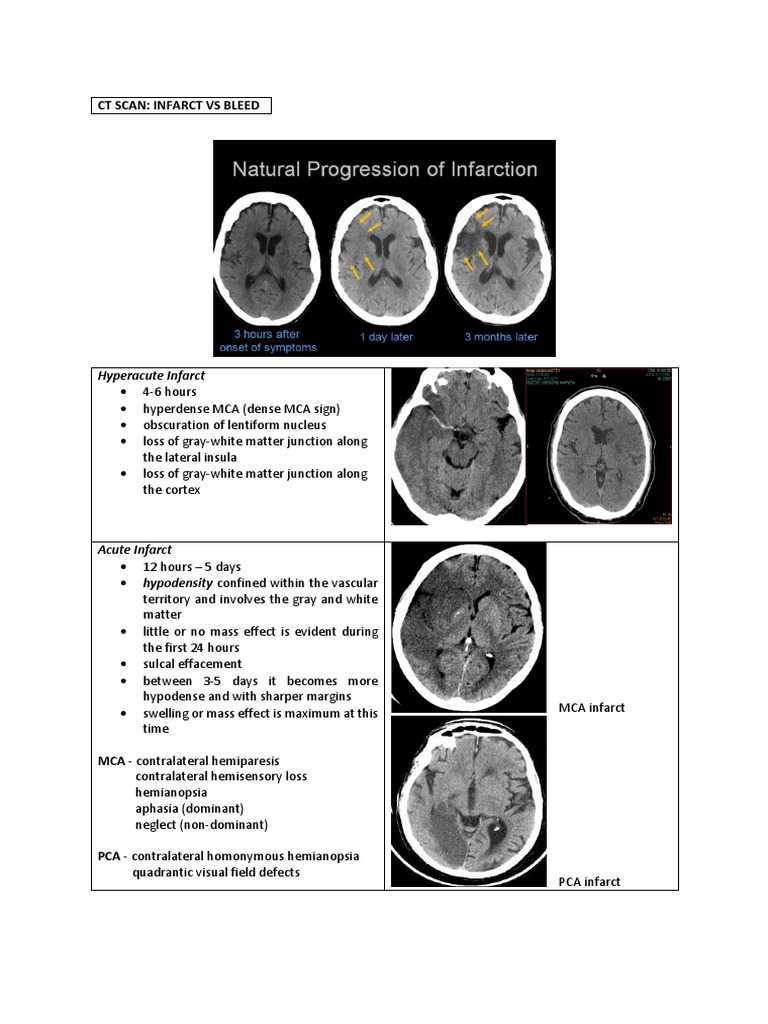 CT Scan: Infarct vs. Hemorrhage Analysis | PDF | Nervous System ...