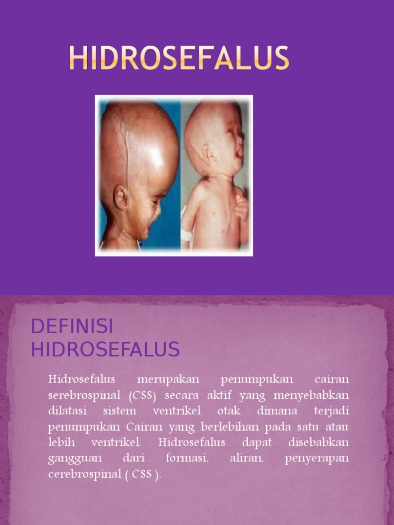 Penyuluhan Ppt-Hidrosefalus | PDF