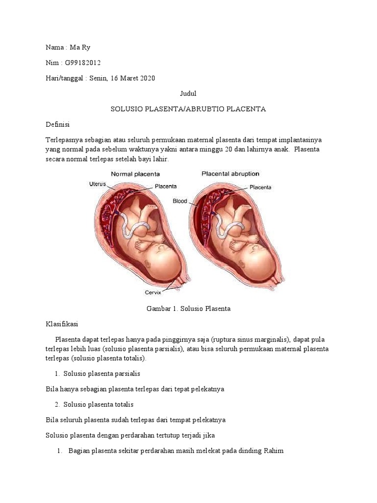Resume Solusio Plasenta | PDF