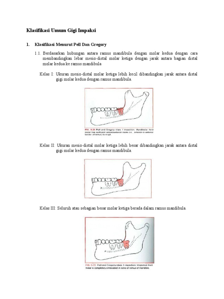 Klasifikasi Umum Gigi Impaksi | PDF