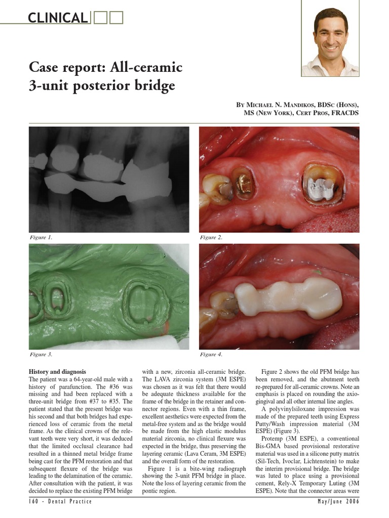 All-Ceramic 3-Unit Posterior Bridge PDF | PDF | Health Sciences | Dentistry