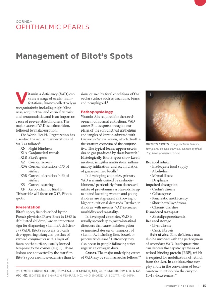 BITOT'S SPOTS: EVALUATION AND TREATMENT OF VITAMIN A DEFICIENCY | PDF ...