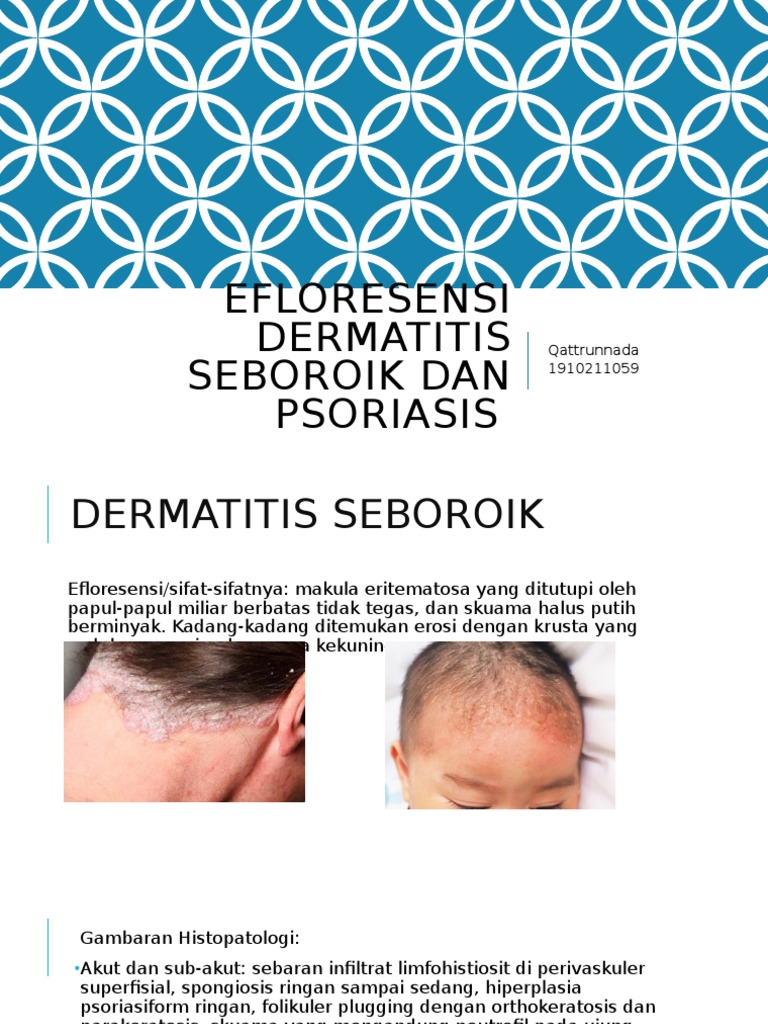 Efloresensi Dermatitis Seboroik Dan Psoriasis | PDF