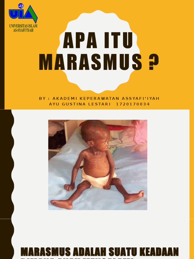 Apa Itu Marasmus | PDF