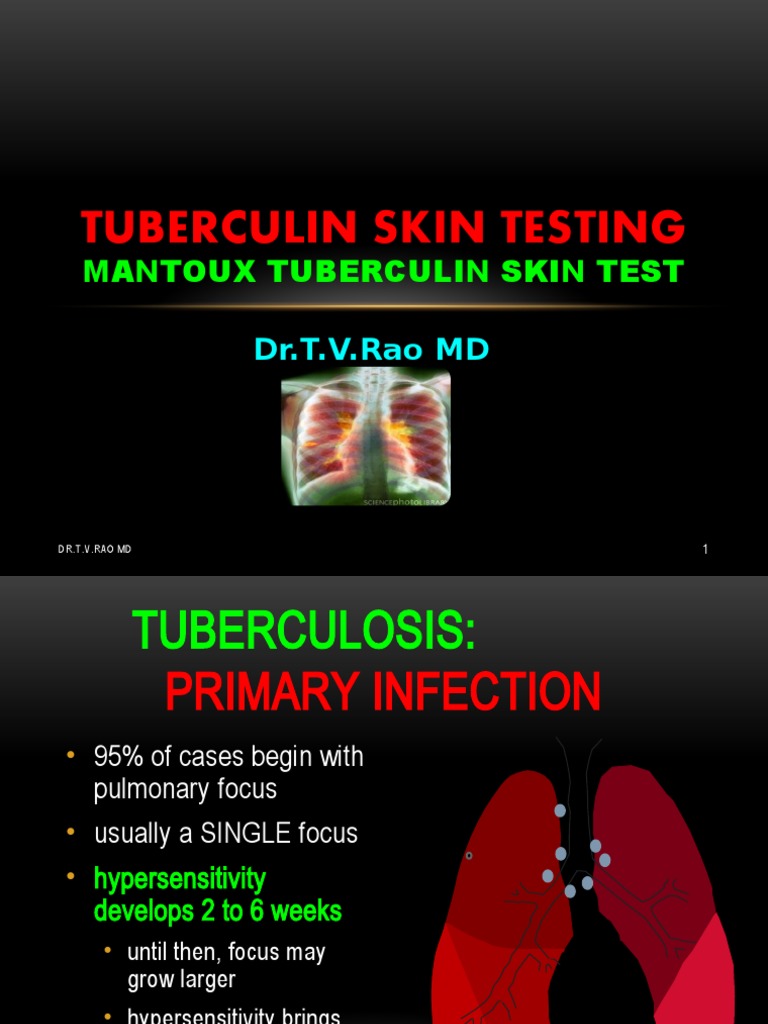 16 Mantoux Test | PDF | Tuberculosis | Public Health