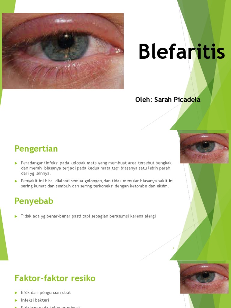 An Overview of Blepharitis | PDF