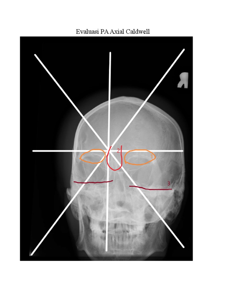 Evaluasi PA Axial Caldwell | PDF