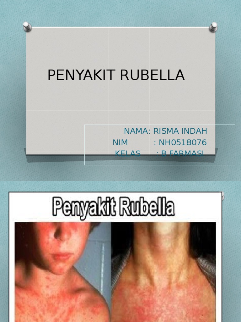 Penyakit Rubella Risma Indah NH0518076 (B) | PDF