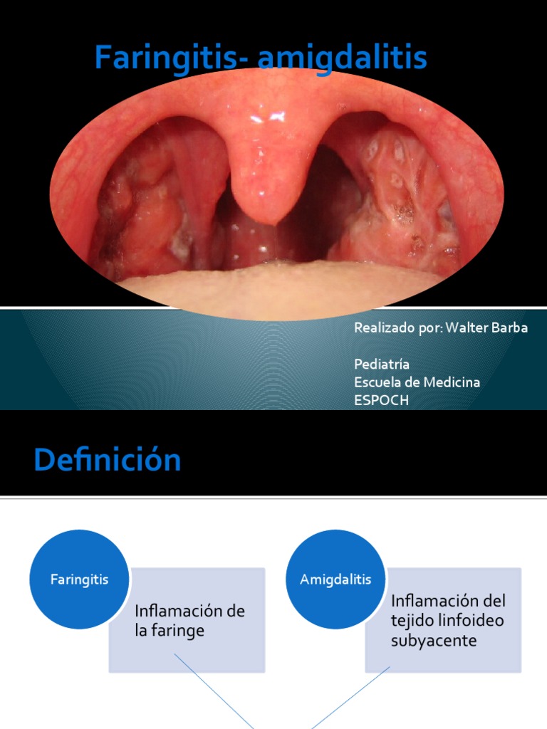 Faringitis Estreptocócica Versus Amigdalitis Recomendaciones Para El