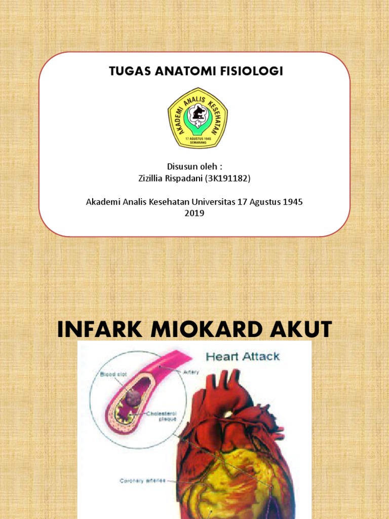 Infark Miokard Akut | PDF