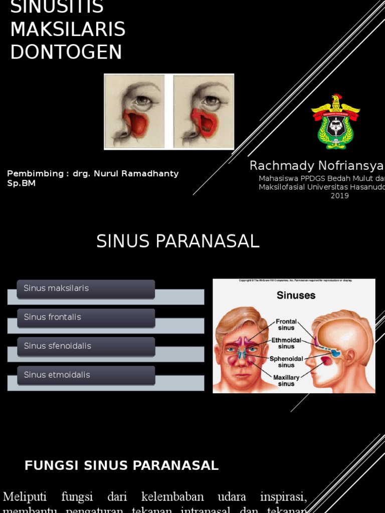 Rona Sinusitis Maksilaris Dontogen | PDF
