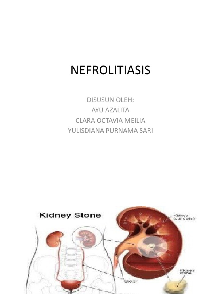 NEFROLITIASIS | PDF