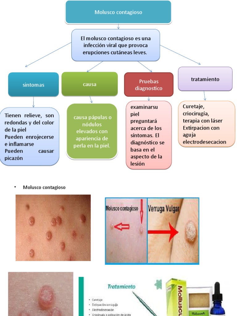 Molusco Contagioso: Síntomas y Tratamiento | PDF