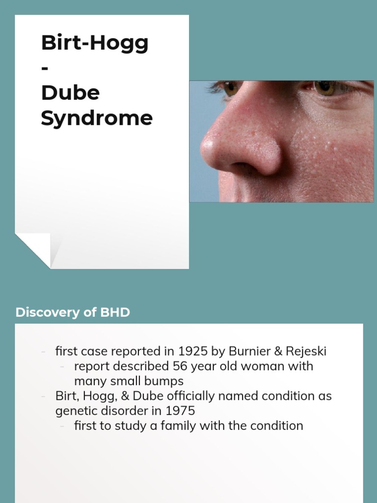 Birt Hogg É Syndromdubesyndrome: Birt Hogg Dube症候群 画像 – SZHSO