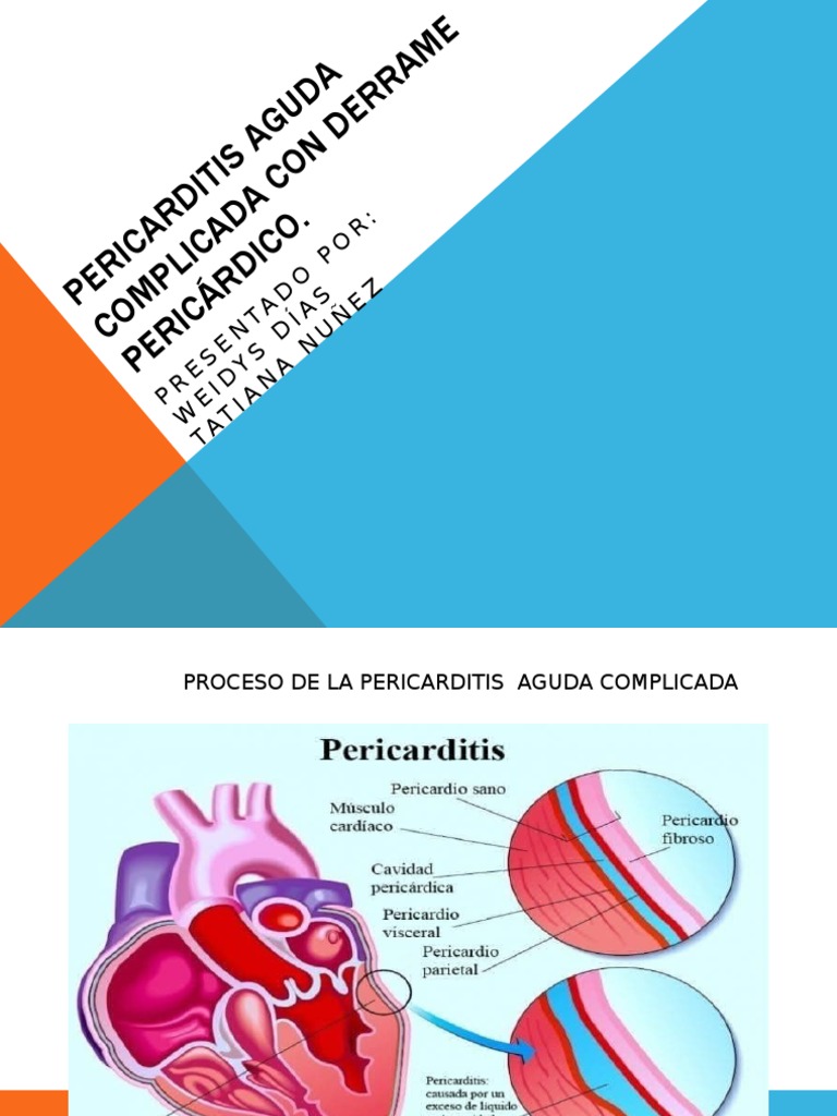 Pericarditis Aguda y Derrame Pericárdico | PDF | Enfermedades y ...