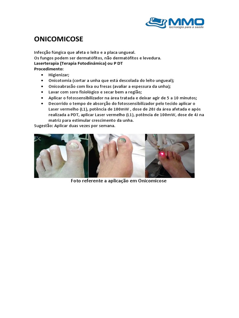 ONICOMICOSE - Protocolo MMO | PDF