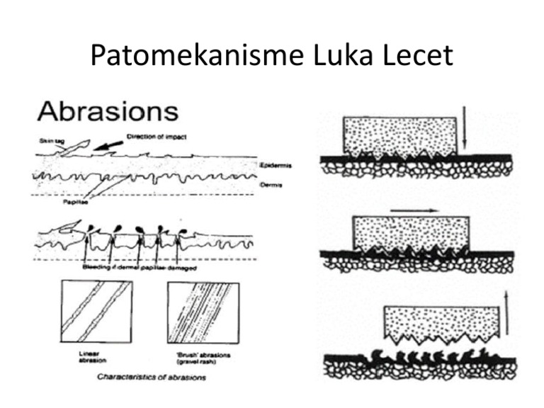 Patomekanisme Luka Lecet | PDF
