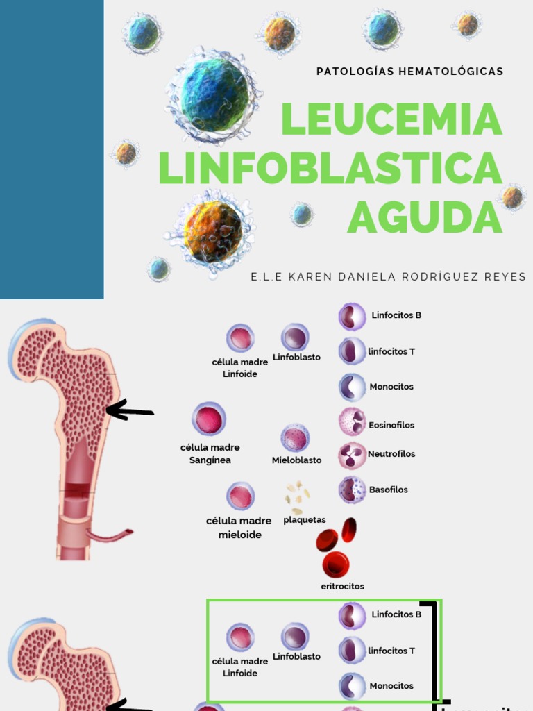 Leucemia Linfoblastica Aguda PDF | PDF | Leucemia | Linfocitos