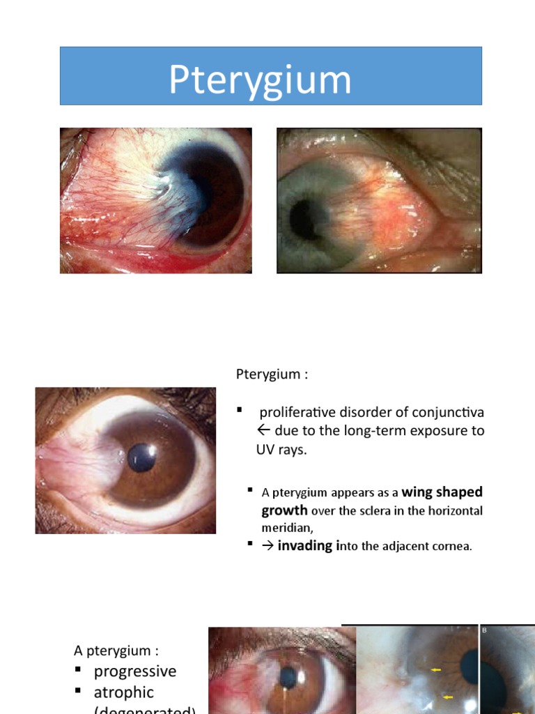 2020 - Pterygium | PDF | Surgical Specialties | Diseases Of The Eye And ...