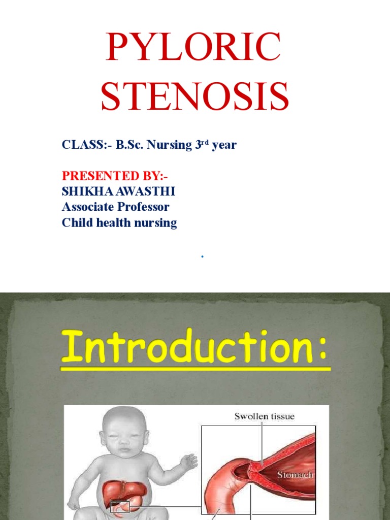 Pyloric Stenosis: CLASS:-B.Sc. Nursing 3 Year | PDF | Medical ...