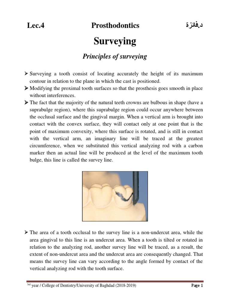 Principles of Surveying Teeth for Removable Partial Dentures | PDF ...