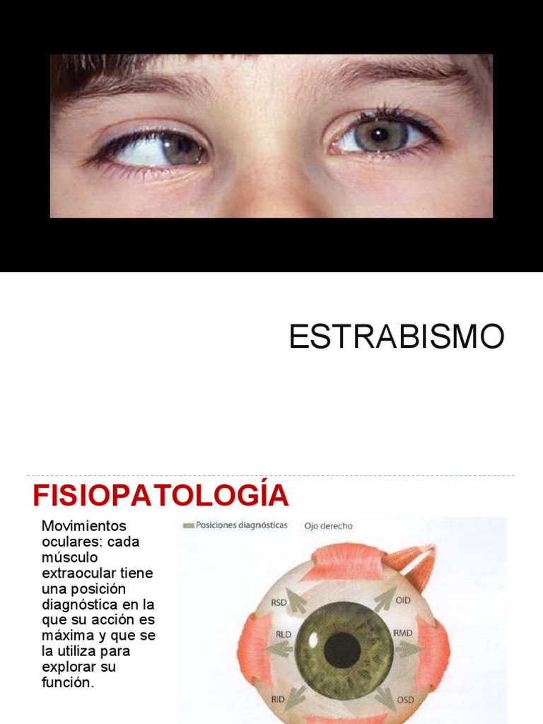 Estrabismo 150615033809 Lva1 App6892 | PDF | Percepción visual | Ojo humano